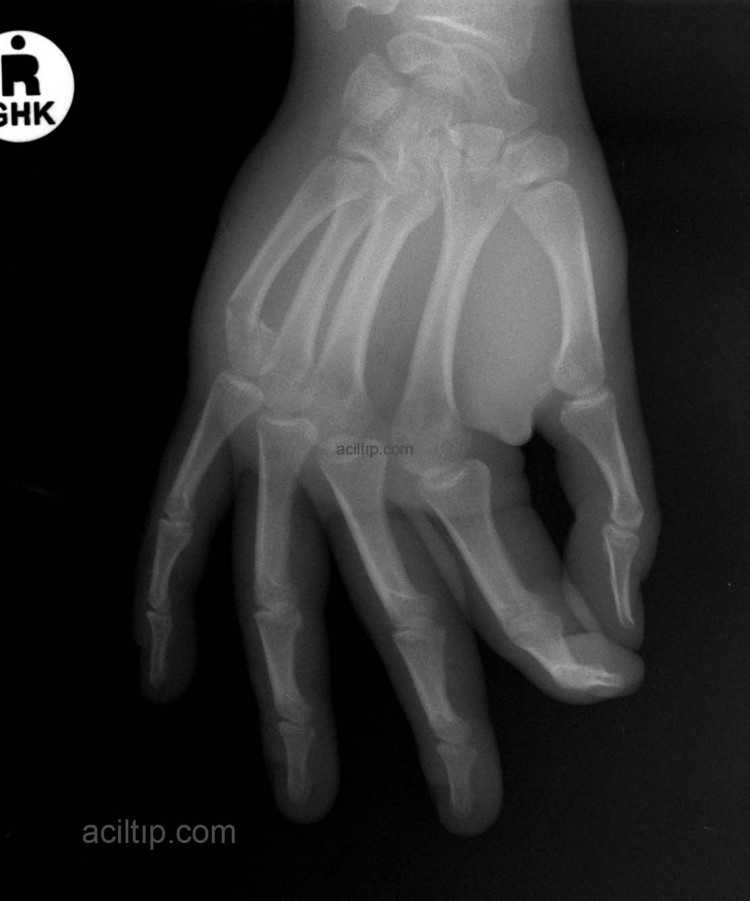 Ekstremite Grafileri | aciltıp.com