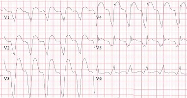 Ventriküler Taşikardi (VT) Nedir? | aciltıp.com