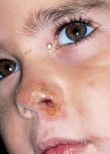 İmpetigo Nedir? | aciltıp.com